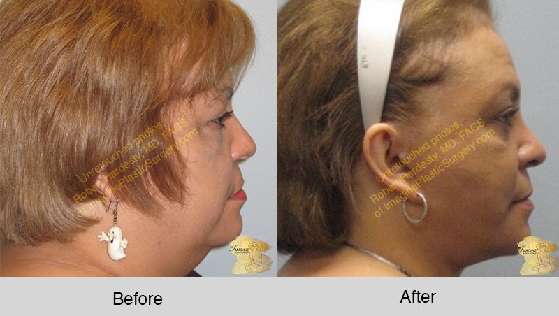 Facelift Before After Photos Patient 67197