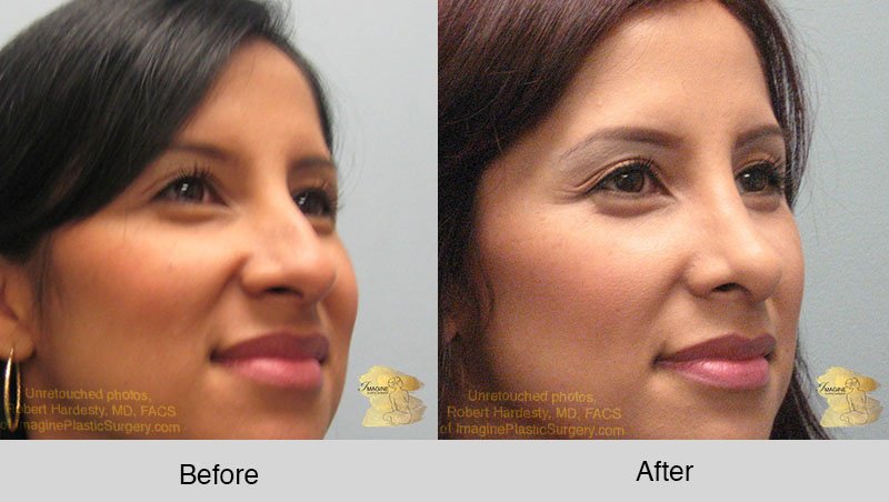 Nose Surgery Before After Photos Patient 87117