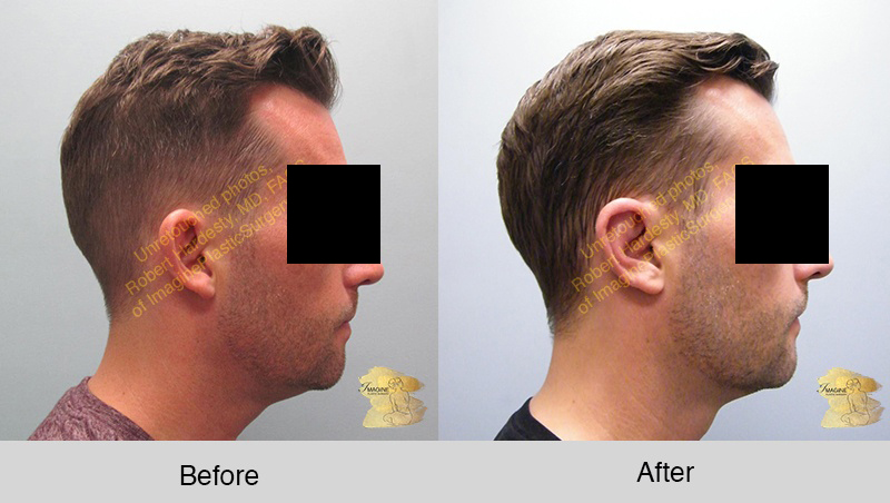 Ear Surgery Before and After Photos Riverside CA