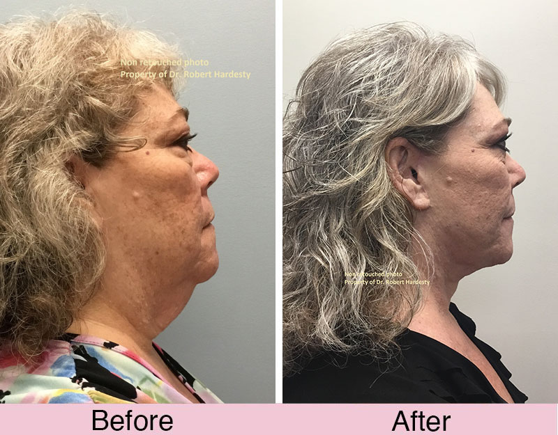 Patient 121461 Before and After Photos Riverside CA