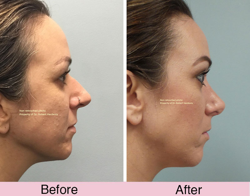 Patient 171171 Before and After Photos Riverside CA