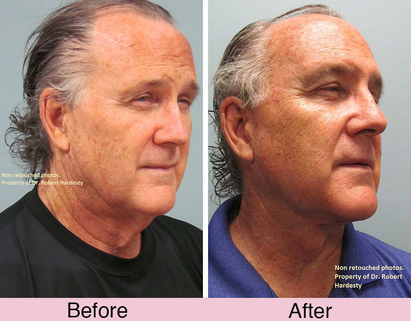 Patient 101231 Before and After Photos Riverside CA