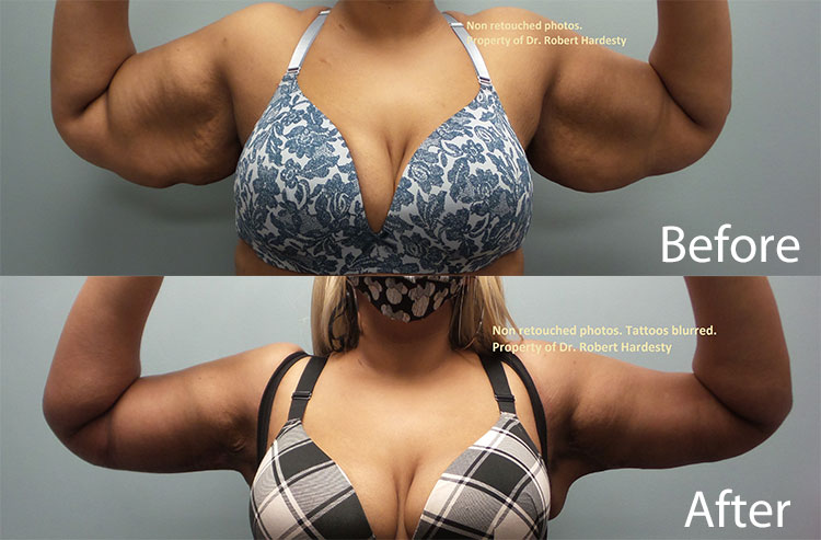 Xl Breast Implants Before And After