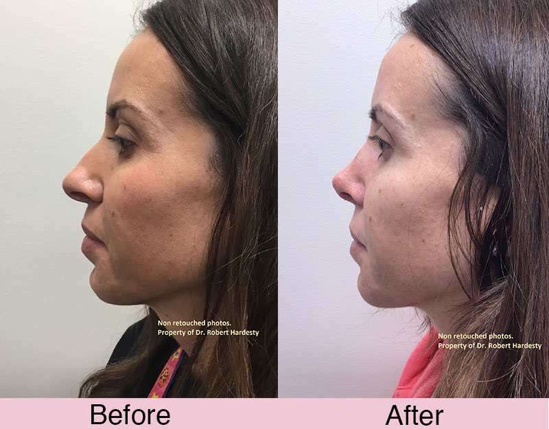 Patient 231574 Before and After Photos Riverside CA
